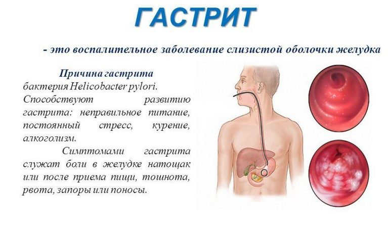 Почему Бывает Отрыжка: Причины, Лечение + 10 Способов Избежать